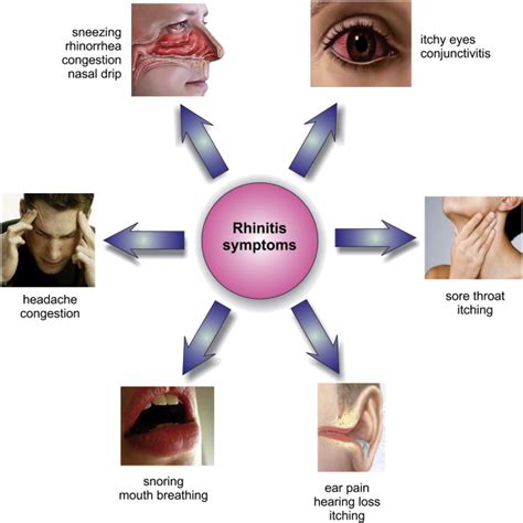 Five Symptoms Of Allergic Rhinitis Reva Pharma