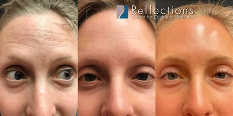 Botox Frown Lines Before And After