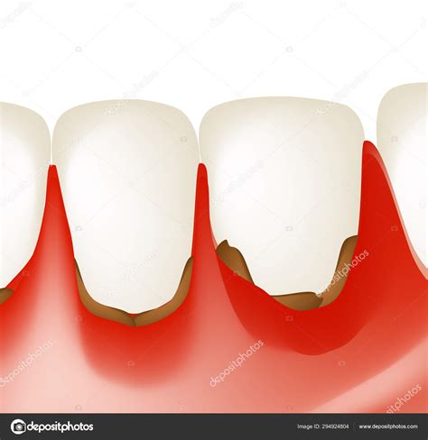 Gengivite Inflamação das gengivas Cálculo dentário Infográficos
