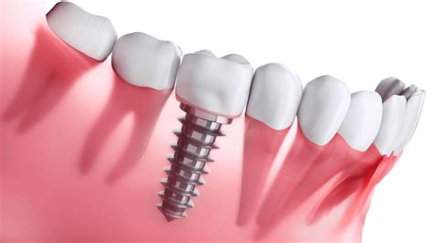 O Que S O Implantes Dent Rios