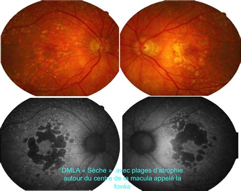 Pathologies Oculaires traitement rétine lyon Centre Rabelais Lyon
