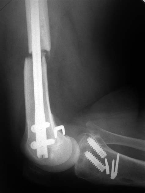 Medical Apparatus Imaging Guide Fracture Fixation