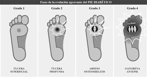 GUSTAVO PAVKA PODÓLOGO Pie del Diabético