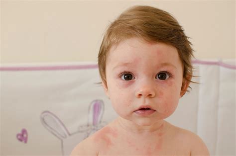 Choroba bostońska u dzieci i dorosłych objawy i leczenie HelloZdrowie