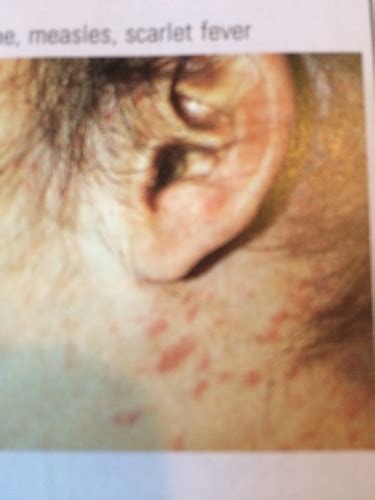 Skin Lesions Flashcards Quizlet