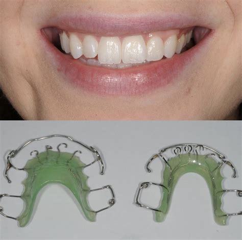 Yes We Can Create Nighttime Active Retainers Lemchen Salzer