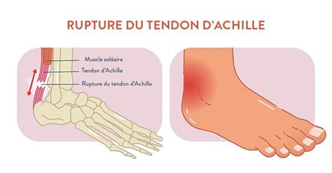 Symptômes et diagnostic de la rupture talon d Achille Dr Paillard
