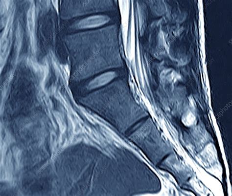 Healthy Spine MRI Scan Stock Image C048 7263 Science Photo Library