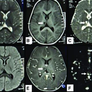 Follow Up Mri After Months Axial T Weighted A T Weighted B
