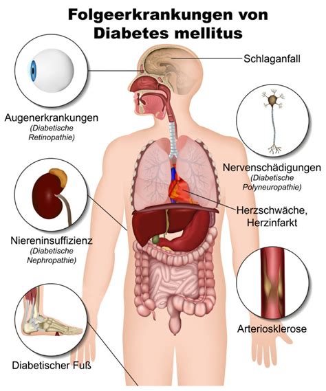 Folgeerkrankungen Bei Diabetes Verhindern Heilpraxis