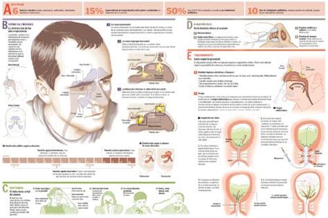 Sinusitis Síntomas diagnóstico y tratamiento Clínica Universidad de