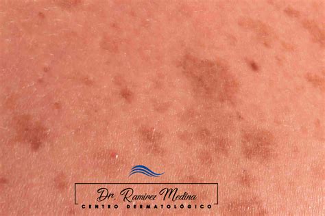 Centro Dermatológico Dr Ramírez Medina Sección Hombres LENTIGOS SOLARES