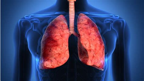 Fibrosis pulmonar causas síntomas y tratamiento