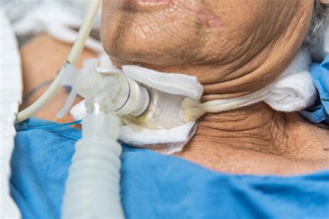 Tracheostomy 101 About Procedure Risks Purpose Homage Malaysia