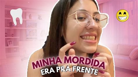 Classe Em Ortodontia Antes E Depois Youtube