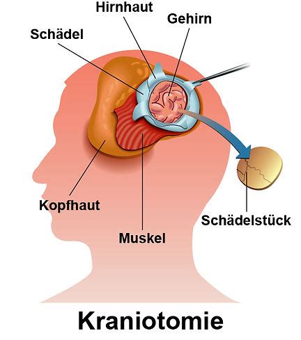 Kraniotomie Neurochirurgie Prof Mendelowitsch