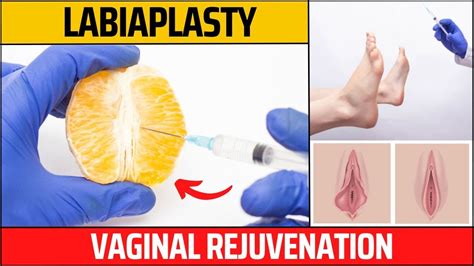 Vagina Rejuvenation Or Labiaplasty Surgery In Chennai Tamira Plastic