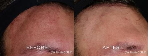 Port Wine Birthmarks Miami Dermatology Laser Institute