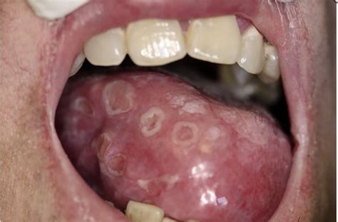 Pictures Syphilis All Stages Warning Strong Images