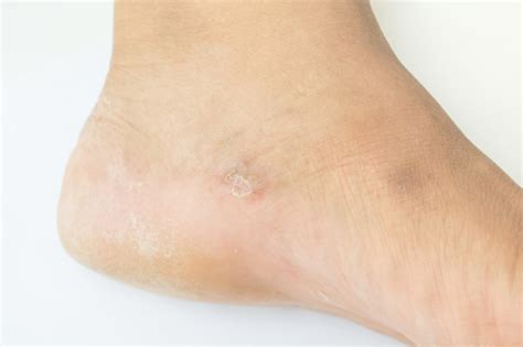 Los Hongos De Los Pies Causas S Ntomas Y Tratamientos Bienvenido