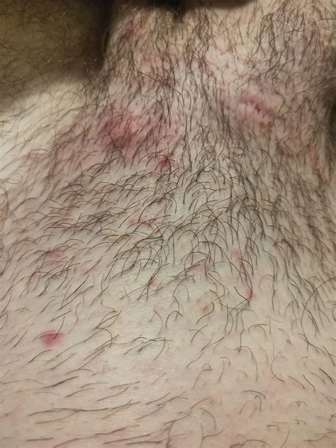 Pubic Ingrown Hair Cyst