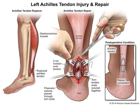 Achilles Rupture Podiatry Orthopedics And Physical Therapy