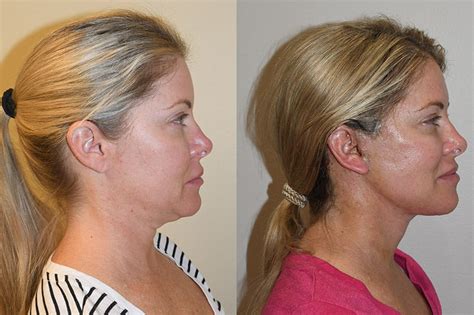Deep Plane Facelift Best Deep Plane Facelift Charleston SC