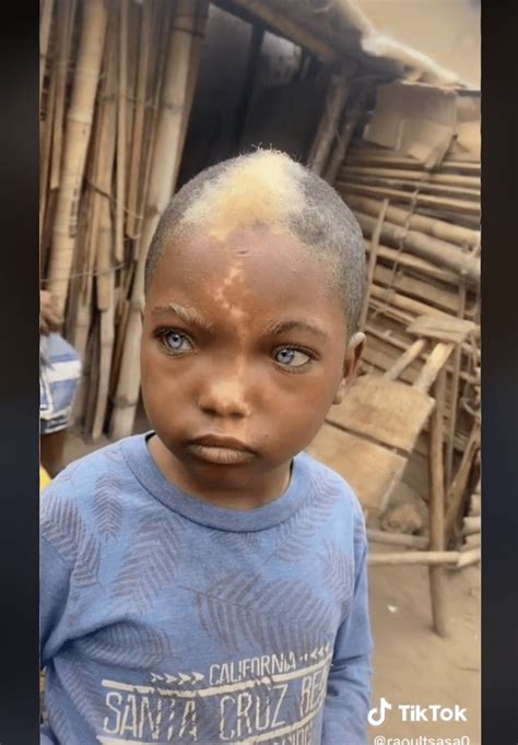 Boy Is Born With Natural Blue Eyes Lightning Birthmark White Hair