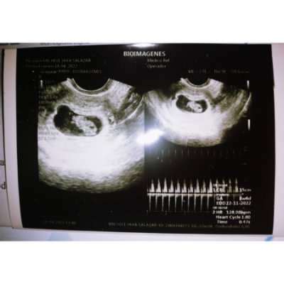Cómo saber si es niño o niña en ecografía de 8 semanas Gastropatios