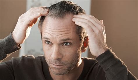 Le Meilleur Traitement Pour La Perte De Cheveux Chez Les Hommes Un