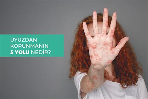 Son Günlerde Çevremizde Çokça Duymaya Başladığımız Uyuz Hastalığı 6