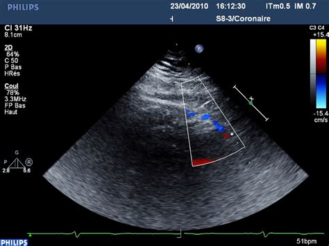 Échocardiographie Doppler Couleur echocardiographie couleur