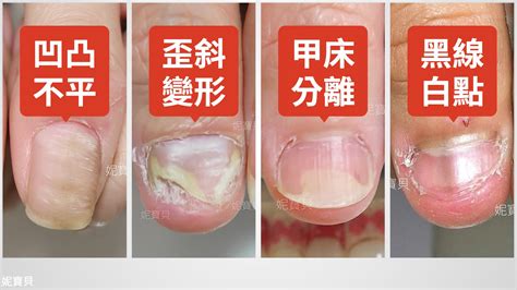 大拇指常見問題 甲溝炎 凹凸不平 歪斜變形 甲床分離 黑線白點