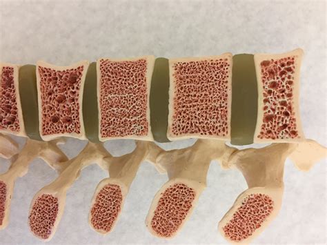 Osteoporoza Przyczyny Objawy B Lowe Badania Leczenie