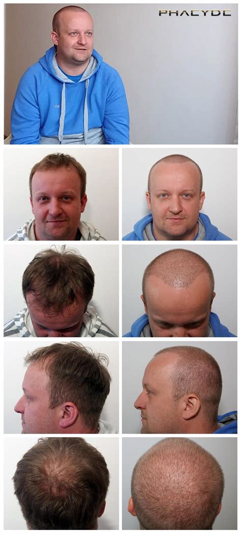 Haartransplantation Und Haarpigmentierung Bevor Nachher Fotos Ergebnisse