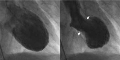Takotsubo Cardiomyopathy Broken Heart Syndrome
