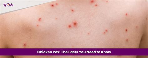 Chicken Pox The Facts You Need To Know WoW Health