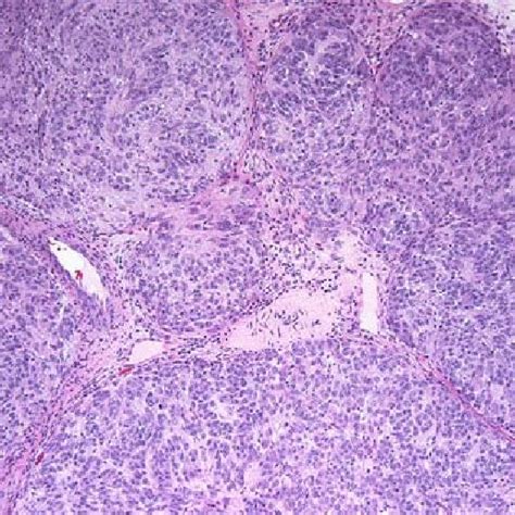 Nine Tumors Arose In A Benign Schwannoma A Conventional Schwannoma