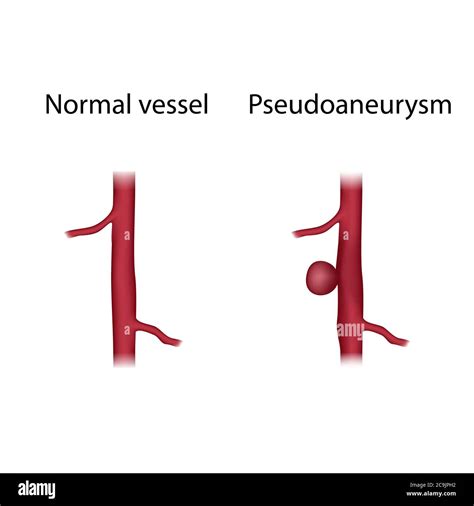 Pseudoaneurysm Hi Res Stock Photography And Images Alamy