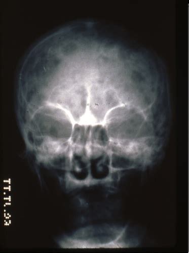Imaging Flashcards Quizlet