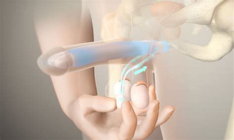 Penile Prosthesis The BEST Surgical Treatment For ED In Lebanon