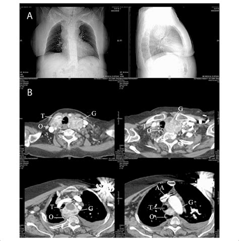 patient 2 preembolization computed tomography scan a anteroposterior download scientific