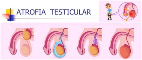 O Que Acontece Se Atrofia Testicular