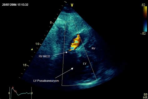 A Rare Complication Of Left Ventricular Rupture Right Ventricular