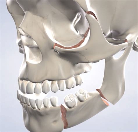 Facial Trauma In Norton Shores MI Breakwater Oral Maxillofacial