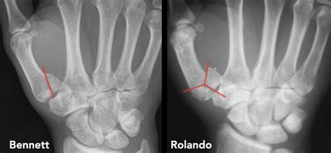 Rolando Fracture Litfl Medical Eponym Library
