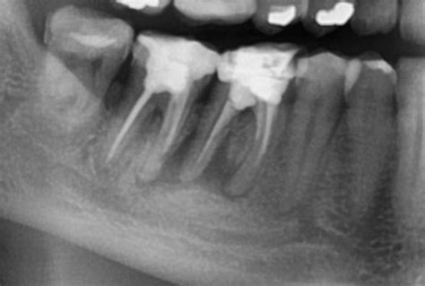 Endodoncja leczenie kanałowe pod mikroskopem