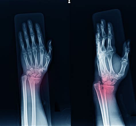 Distal Radius Wrist Fractures Advanced Hand Wrist Nerve Centre