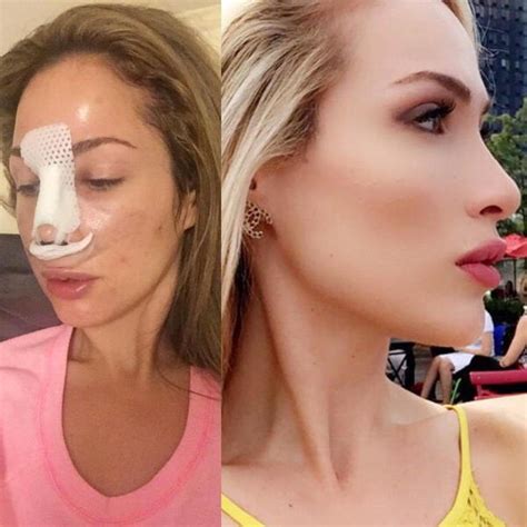 Bulbous Rhinoplasty Before And After Rhinoplasty Cost Pics Reviews