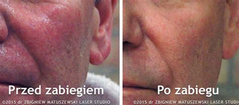 Laserowe Usuwanie Rozszerzonych Naczynek I Rumienia Laser Studio